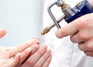 Entfernung von Warzen - Removio